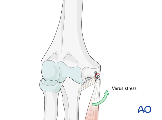 Repair of medial collateral ligament