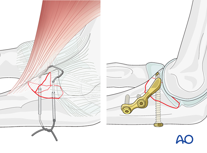Ulna Articular Coronoid Fracture Repair Of Coronoid Fractures
