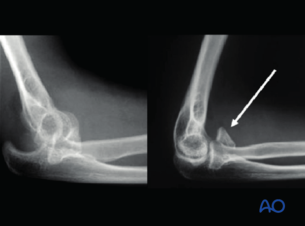 Ulna Articular Coronoid Fracture Repair Of Coronoid Fractures