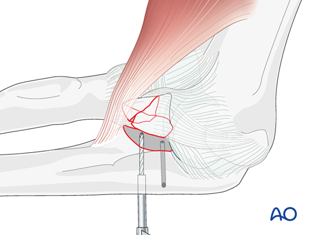 Ulna Articular Coronoid Fracture Repair Of Coronoid Fractures