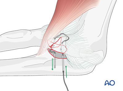 Repair of coronoid fracture for Ulna, articular, coronoid