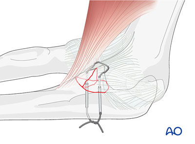 Repair of coronoid fracture for Ulna, articular, coronoid