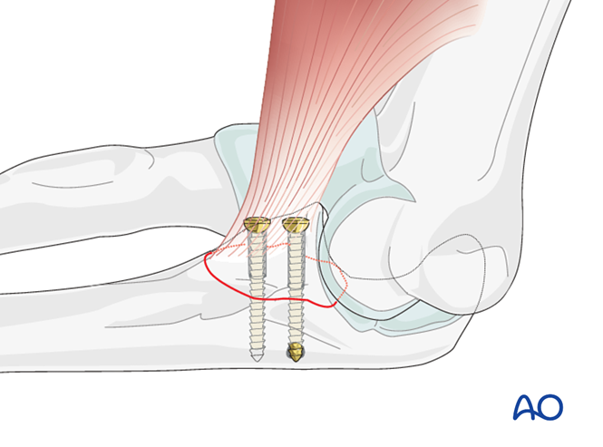 Ulna, articular, coronoid fracture - Repair of coronoid fractures