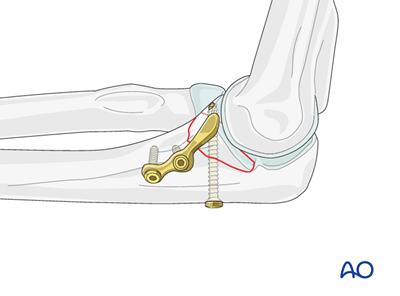 Repair of coronoid fracture for Ulna, articular, coronoid