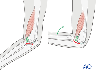 Repair of coronoid fracture for Ulna, articular, coronoid