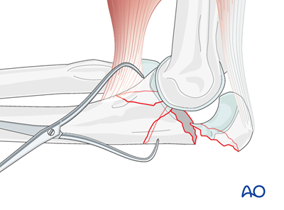 Repair of coronoid fracture for Ulna, articular, coronoid