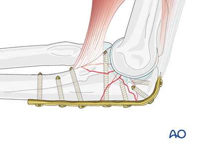 Repair of coronoid fracture for Ulna, articular, coronoid