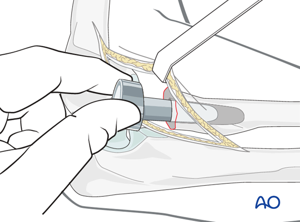Radial Head Arthroplasty For Radius Complete Articular