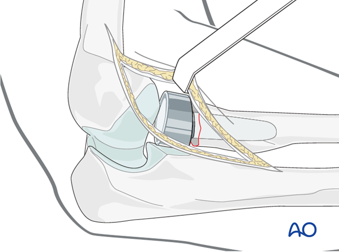 Radial head arthroplasty for Radius, complete articular