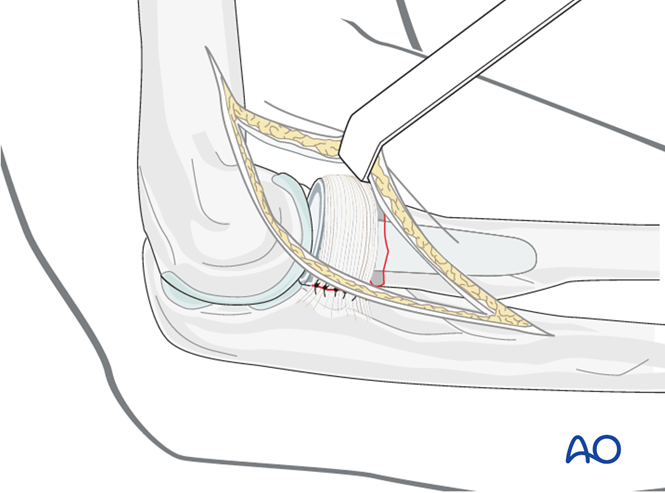 Radial head arthroplasty for Radius, complete articular