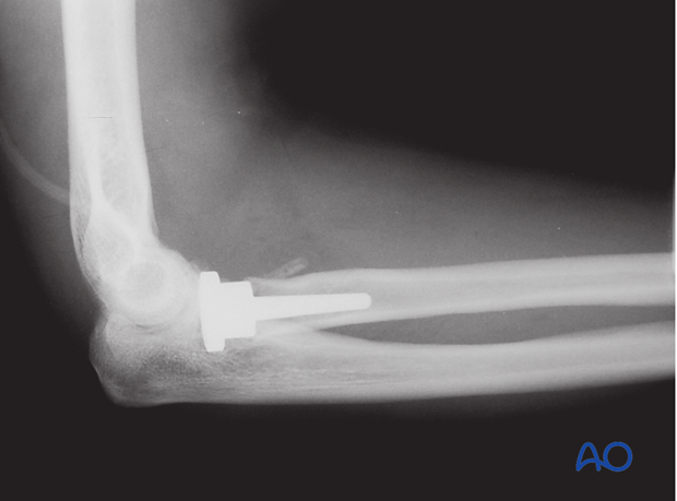 Radial Head Arthroplasty For Radius Extraarticular Multifragmentary
