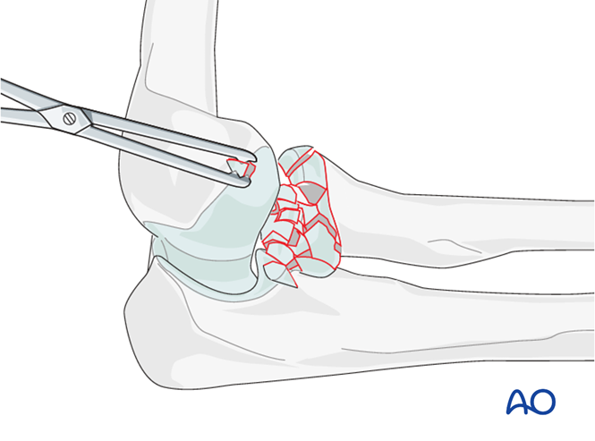 Radial head excision for Radius, complete articular