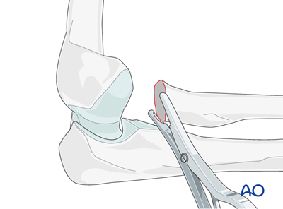Radial head excision for Radius, complete articular