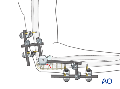 Hinged external fixation following ORIF for Anterior transolecranon ...