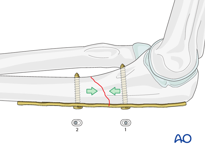 Compression plate and lag screw for Ulna, extraarticular, simple