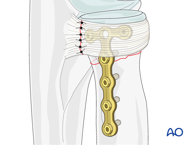 Radius, extraarticular, transverse - Compression with T-plate and screws