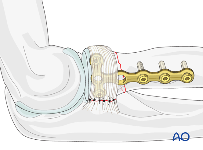 Compression with T-plate and screws for Radius, extraarticular, simple