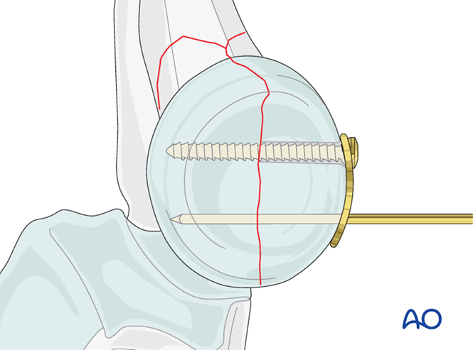 Radius, complete articular - Plate and screws