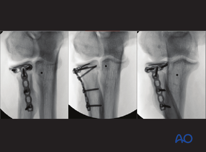 Radius, complete articular - Plate and screws
