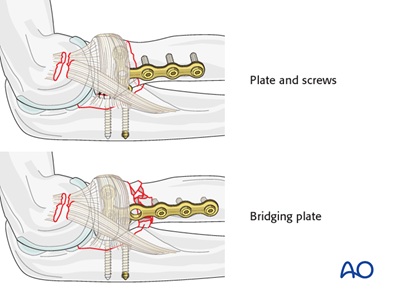 Open reduction internal fixation for Terrible triad