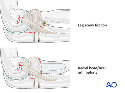 Open reduction internal fixation for Terrible triad