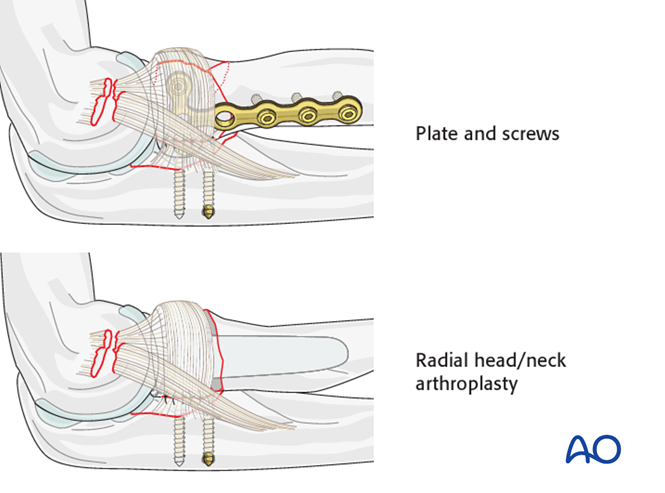 Open reduction internal fixation for Terrible triad