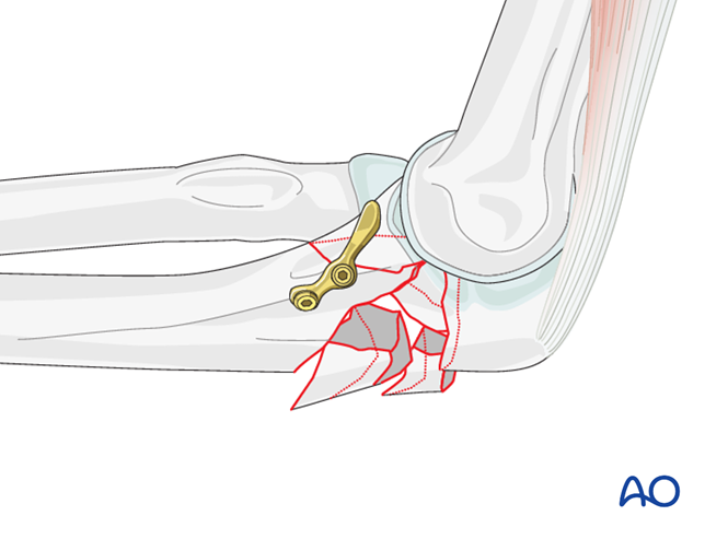 Open reduction internal fixation for Anterior transolecranon fracture ...