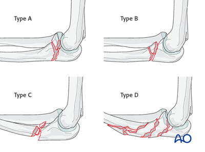 Open reduction internal fixation for Posterior fracture dislocation