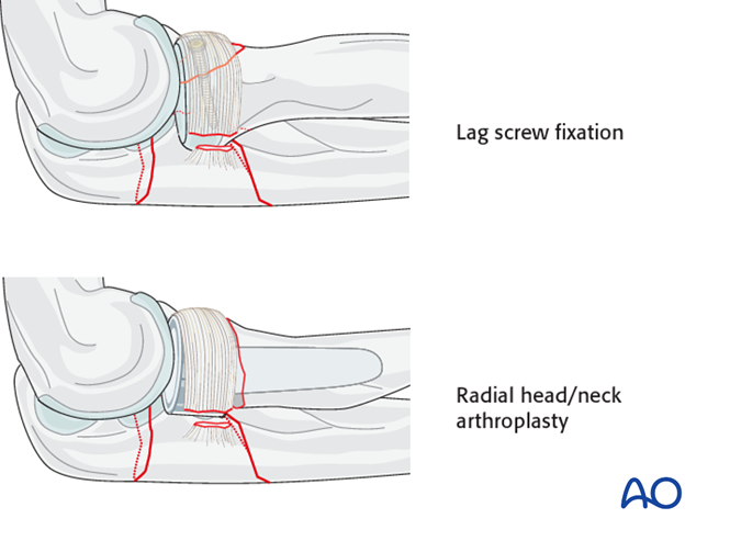 Open reduction internal fixation for Posterior fracture dislocation