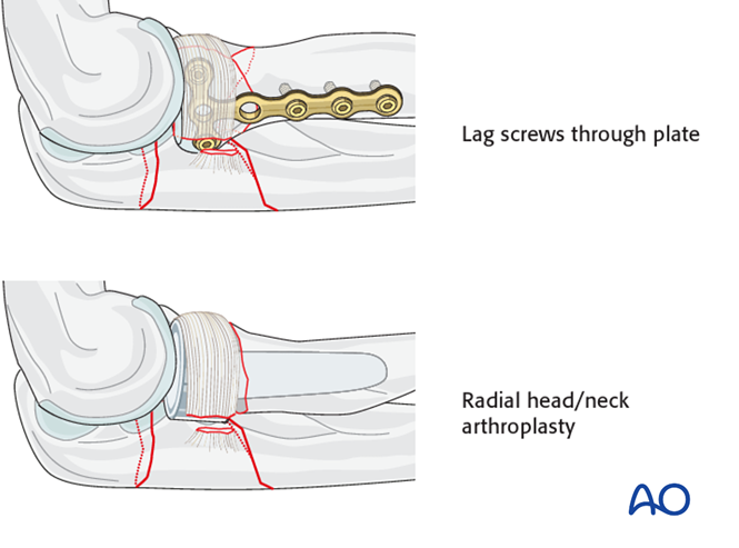 Open reduction internal fixation for Posterior fracture dislocation
