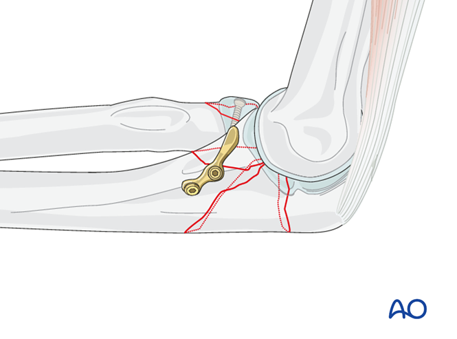 Open reduction internal fixation for Posterior fracture dislocation