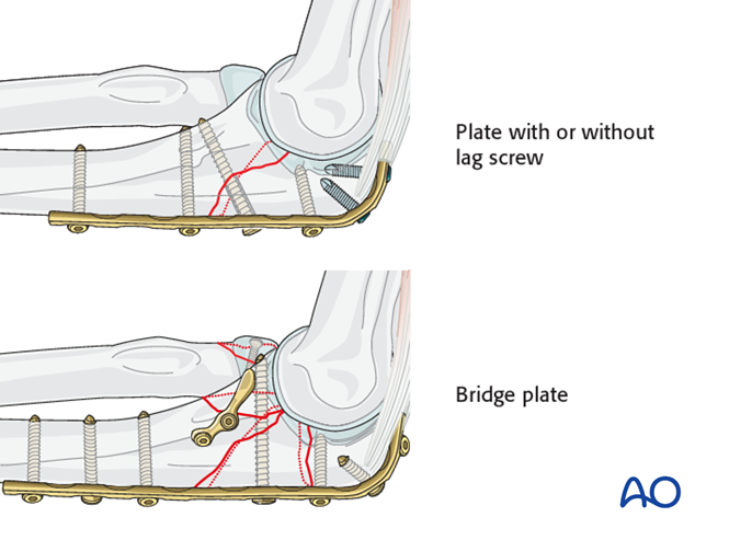 Open reduction internal fixation for Posterior fracture dislocation