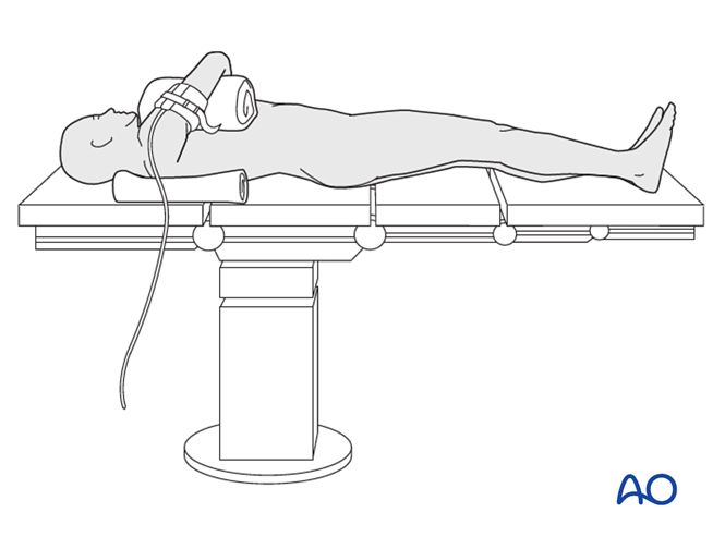 Supine for posterior access