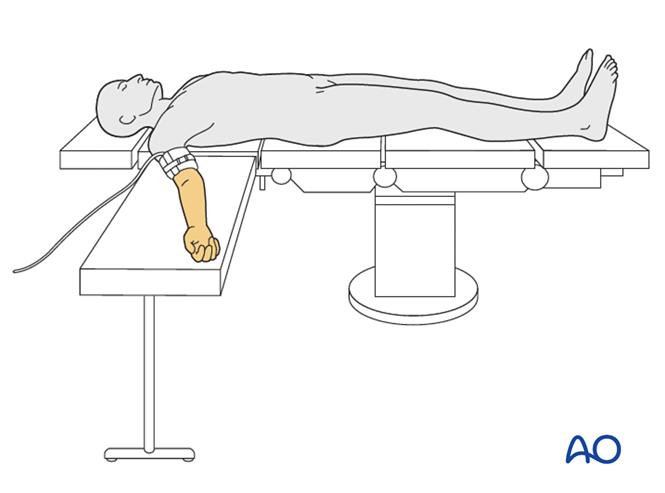 Supine for anterior access