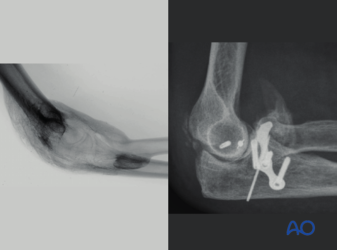 Heterotopic ossification