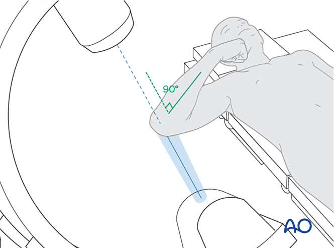 Intraoperative imaging of the proximal forearm