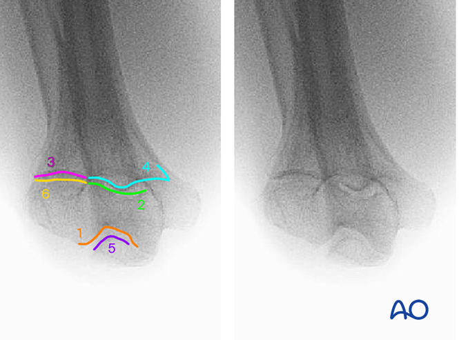 Intraoperative imaging of the proximal forearm
