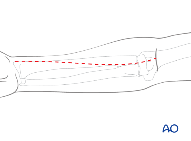 Anterior approach (Henry) to the forearm shaft