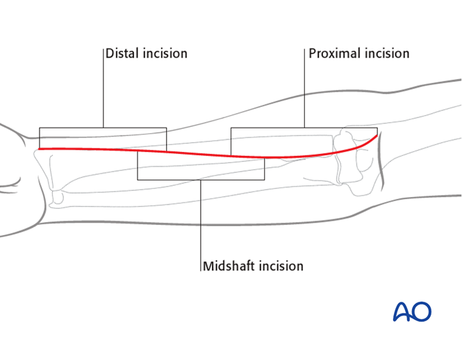 Anterior approach (Henry) to the forearm shaft