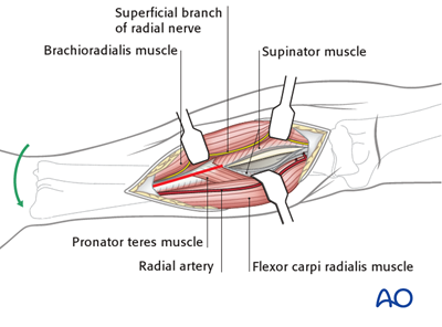 Anterior approach (Henry) to the forearm shaft