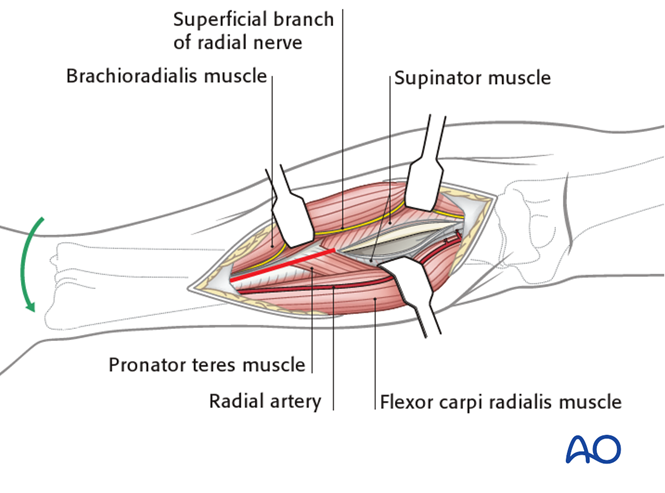 Anterior approach (Henry) to the forearm shaft