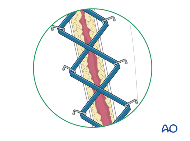 Anterior approach (Henry) to the forearm shaft