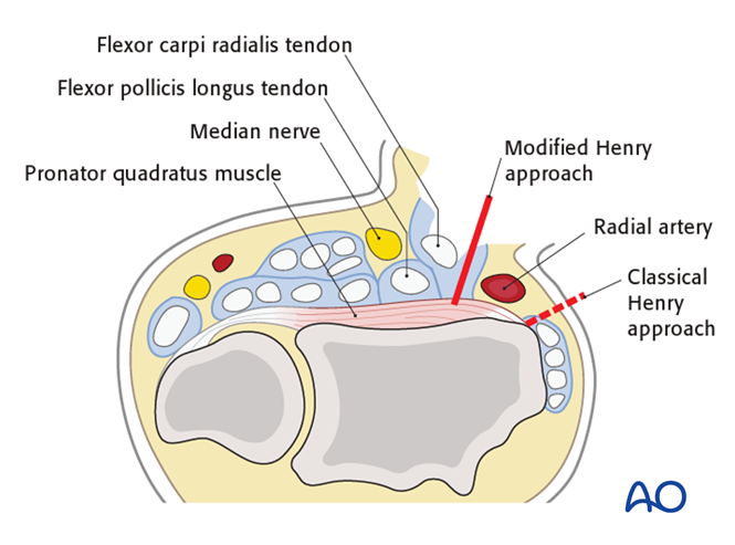 Anterior approach (Henry) to the forearm shaft