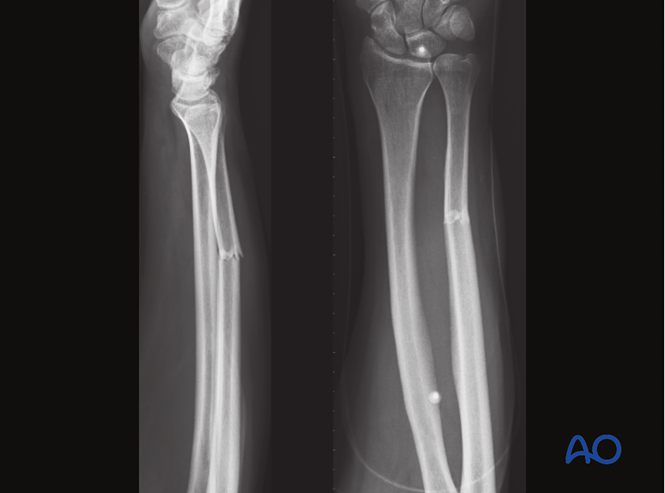 Transverse simple fracture of the ulna