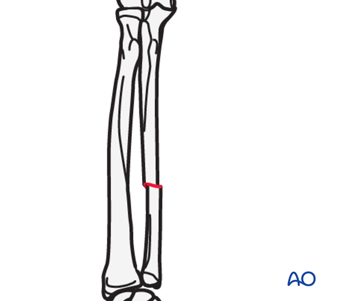 Transverse simple fracture of the ulna