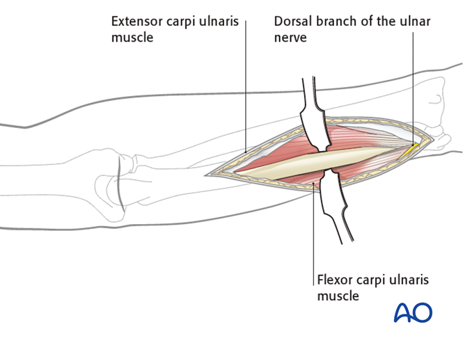 Approach to the ulna