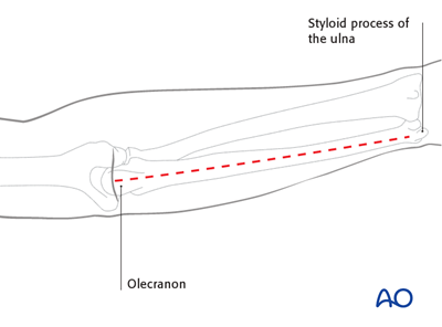 Approach to the ulna