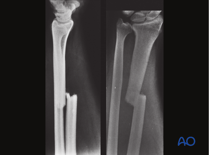 Transverse simple fracture of the radius