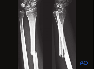 ORIF - Plating for Simple fracture of the radius, with dislocation of ...