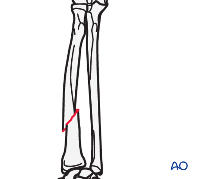 Simple fracture of the radius, with dislocation of distal radioulnar ...